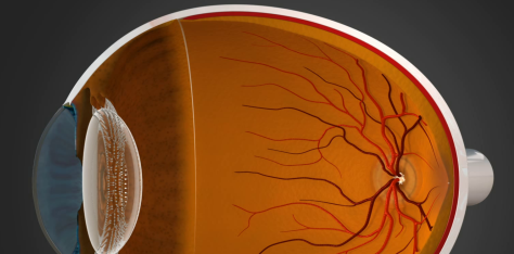 Myopic CNV - Intravitreal Expert Group